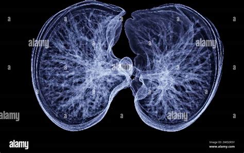 Ct Chest Or Lung 3d Rendering Image Showing Trachea And Lung In