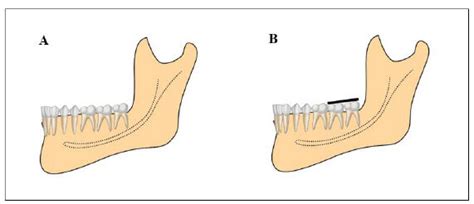 Schematic Drawing Of The Classification Of The Position Of The Lower