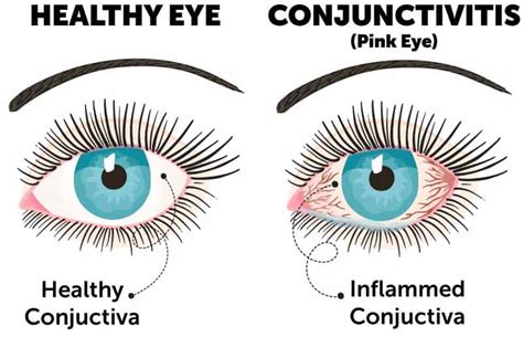 Conjunctiva Diagram