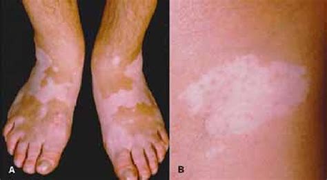 A Generalized Vitiligo Characterized By Symmetrical Depigmented Milky