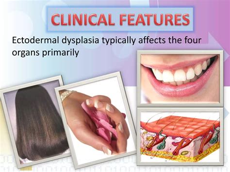 Ectodermal Dysplasia Pptx