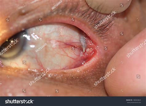 Dermoid Cyst Containing Eye