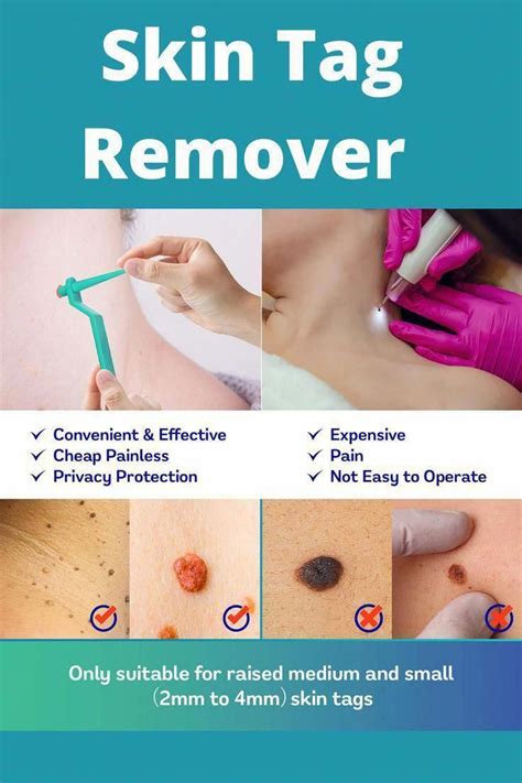 Skin Tag Removal Before Afters Removing From Home Amazonfinds Artofit