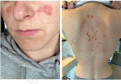 Figure 1 From New Onset Pemphigus Vegetans And Pemphigus Foliaceus