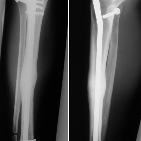 Anteroposterior And Lateral Knee X Ray The Proximal Tibiofibular Download Scientific Diagram
