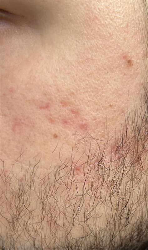 Acne Scars Hyperpigmentation R30plusskincare