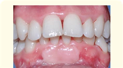 Creeping Attachment And Complete Root Coverage At 2 Nd Year Download