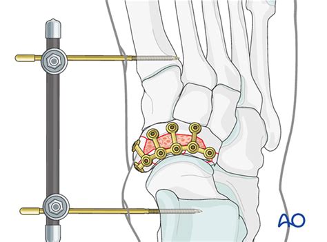 Orif Navicular Plate For Complete Articular Navicular Fracture