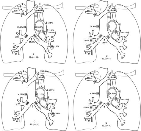 Locoregional Recurrence Pattern Of Left‐sided Lung Cancers A And
