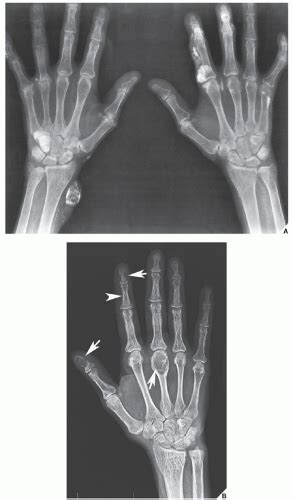 Hyperparathyroidism Radiology Key
