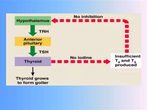 Multi Nodular Goitre Mbbs 3rd Year Pptx