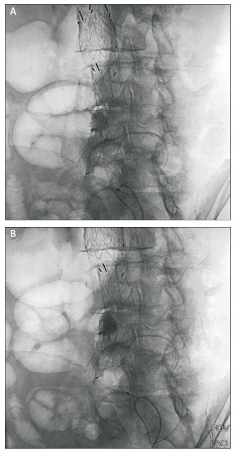 Coiling A Type Ii Endoleak Endovascular Today