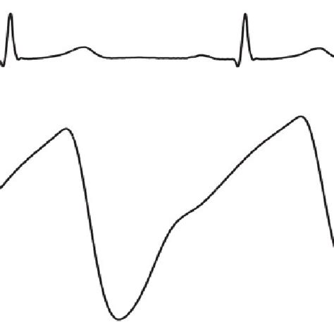 1 AC Component Of PPG Signal Compared To ECG Allen 2007 Download Scientific Diagram