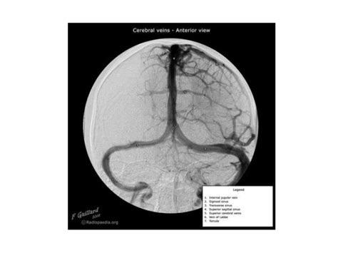 The Two Transverse Sinuses Arise At The Confluence Of The Three Sinuses At The Torcula Herophili