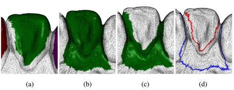 automatic 3d tooth segmentation using convolutional neural networks in