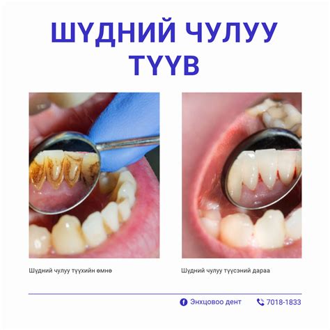 Энхцовоо дент Шүдний чулуу нь олон тооны бактерийг агуулж байдаг учир
