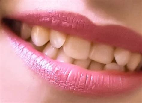 Elastics In Clear Aligner Treatment What They Are And How They Work