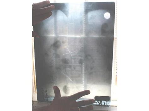 Затворник гълта 22 пирона