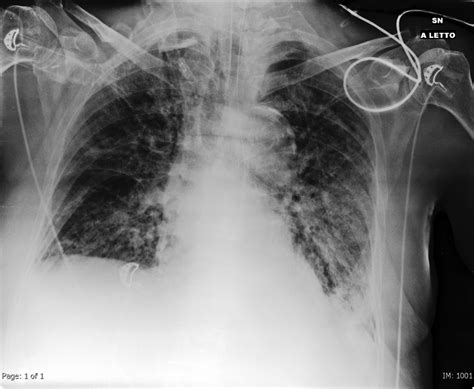 Original Image A And Extracted Lung Segmented Image B Many Download Scientific Diagram