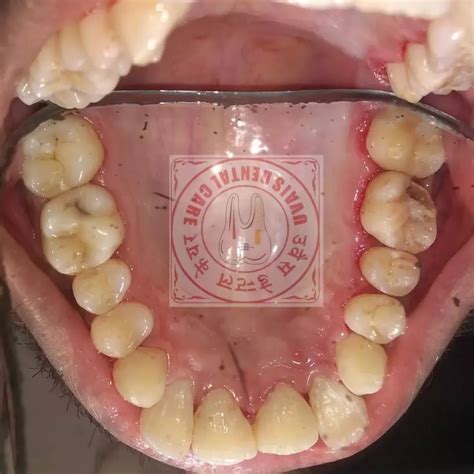A Case Of Heavy Calculus Deposit Uvais Dental Care Facebook