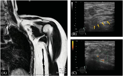 A Mri T2 Weighted Image Shows Enlarged Lymph Nodes With Normal Hilum