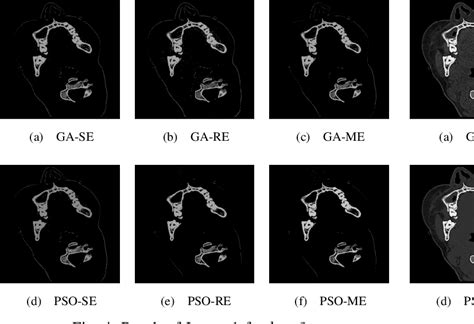 Figure 4 From Comparison Results Of Medical Image Segmentation With Genetic Algorithm And