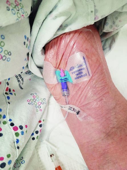 This Picture Shows A Midline Catheter Inserted Into The Patients Left