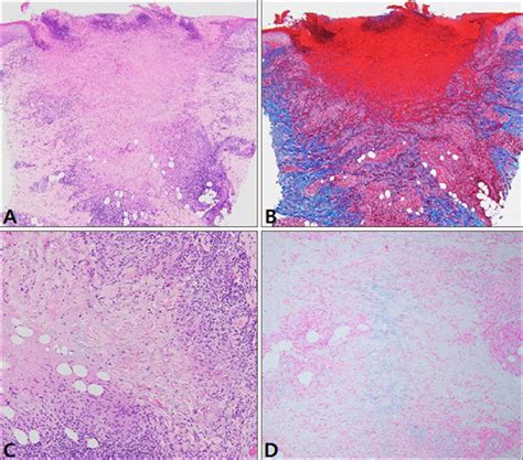 Perforating Granuloma Annulare Mimicking Papulonecrotic Tuberculid