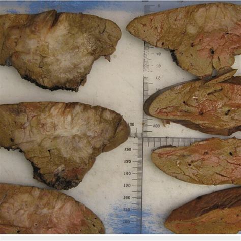 Photo Taken After Hepatic Surgery Right Hepatectomy Download Scientific Diagram