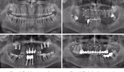 Figure 2 From Report On Tooth Detection And Numbering In Panoramic Radiographs Using Cnns