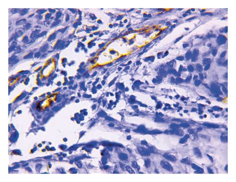 Atypical Dilated Capillaries A Atypical Dilated Capillary In The Download Scientific Diagram