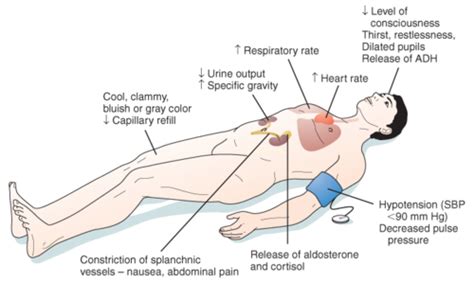 Shock Flashcards Quizlet