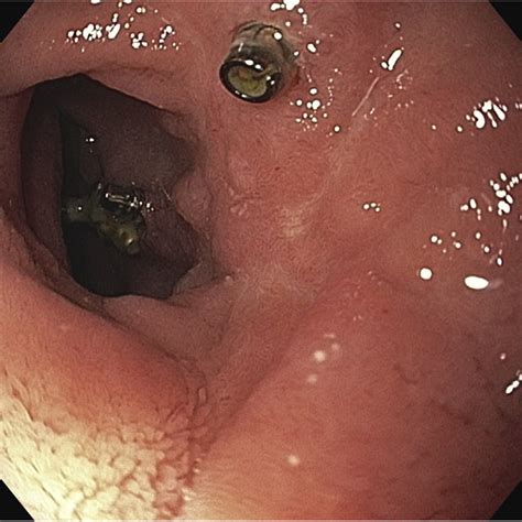 A 30 Mm Sessile Polyp In The Third Portion Of The Duodenum Occupying Download Scientific