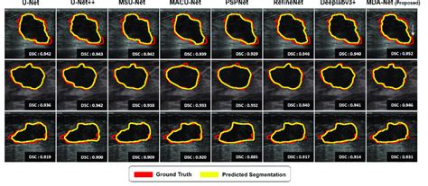 Breast Lesion Segmentation Result Of Three Randomly Selected Samples