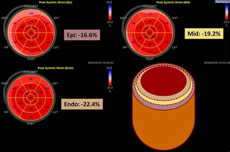 Layer Specific Longitudinal Strain Analysis The Bull Eyes Plots For Download Scientific