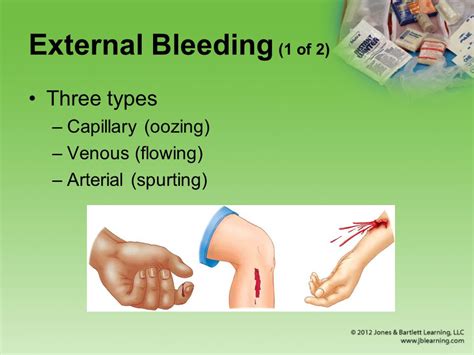 Three Types Of External Bleeding Exploring Different Types Of Piles