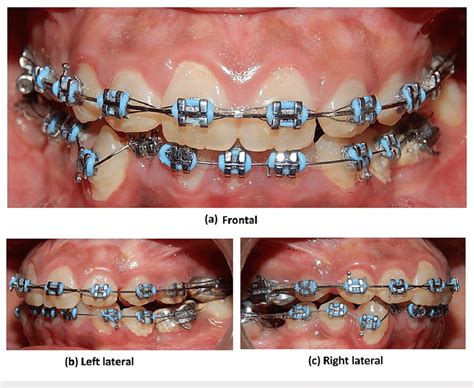 Intraoral Photograph Views Showing Alignment With Upper Arch After Tad Download Scientific