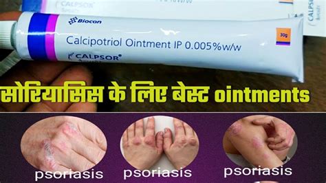Calpsor Ointment Calcipotriol 0005 Ointment Calpsor Ointment Uses Benefit Youtube Calpsor Ointment Calcipotriol 0005 Ointment Calpsor Ointment Uses Benefit Youtube