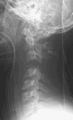 Case X Rays On Admission BGD Fracture Healing Practical Class