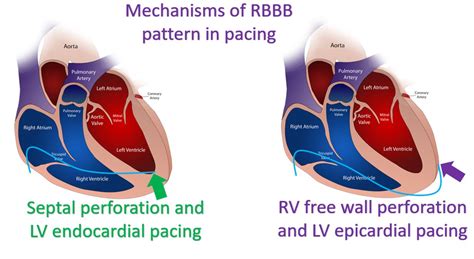 Temporary Pacing Ecg All About Cardiovascular System And Disorders