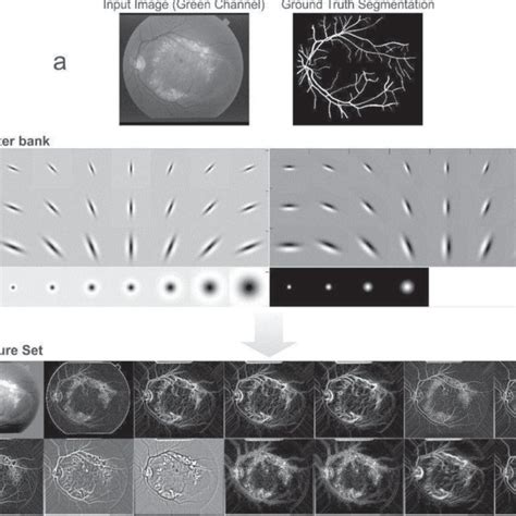 Grading Protocol Icdr And Etdrs Severity Levels Download Table