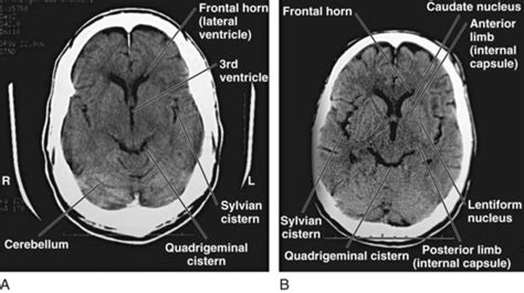 Quadrigeminal Cistern Location The Ed Guide To Neuroimaging Part 1