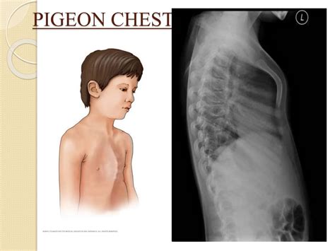 Rickets A Bone Softening Disease Radiologic Signs Pptx