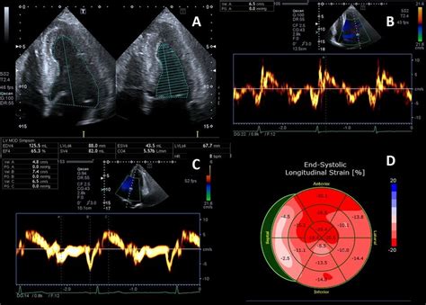 Example Of Fabry Cardiomyopathy With Normal Lv Ejection Fraction Lvef