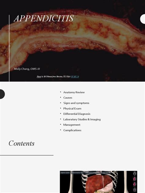 Appendicitis Pdf Clinical Medicine Health Sciences