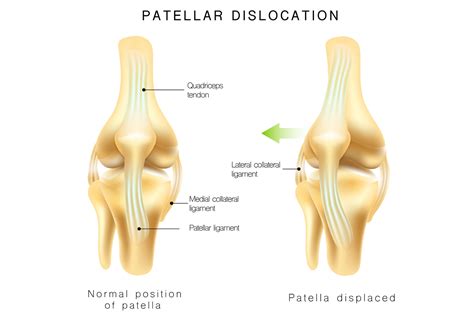 Treating Patellofemoral Dislocation Shelbourne Knee Center