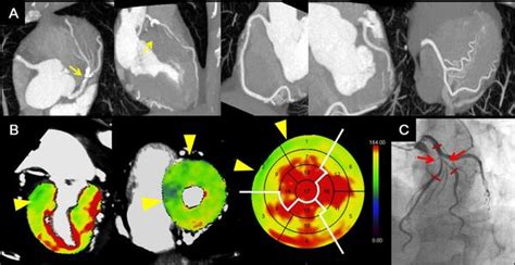 王怡宁、金征宇等关于70kv 低剂量ct心肌灌注成像与基于动态ct心肌灌注扫描提取单期冠状动脉cta的结合应用：与有创ffr对照评估的文章发表于q1杂志 知乎