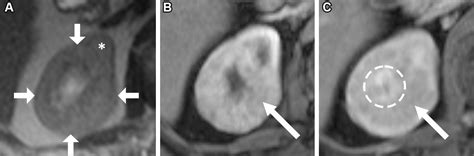Renal Mass Imaging With Mri Clear Cell Likelihood Score A Users Guide