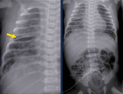 The Radiology Assistant Neonatal Chest X Ray