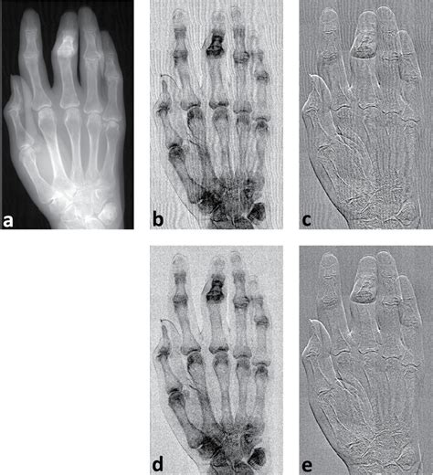 Attenuation Image A Dark Field Image B And Differential Phase